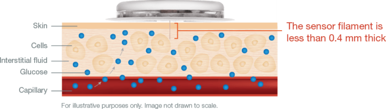 No Needles Necessary: Using the FreeStyle Libre Monitoring System for ...